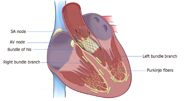 World Journal of Cardiology - Baishideng Publishing Group